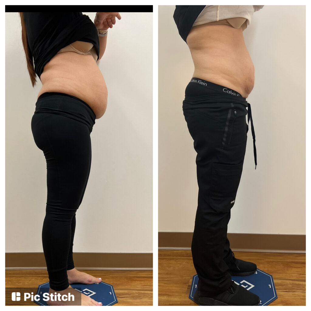 Emsculpt NEO in Sherman Oaks & Agoura Hills, CA | Contour Room