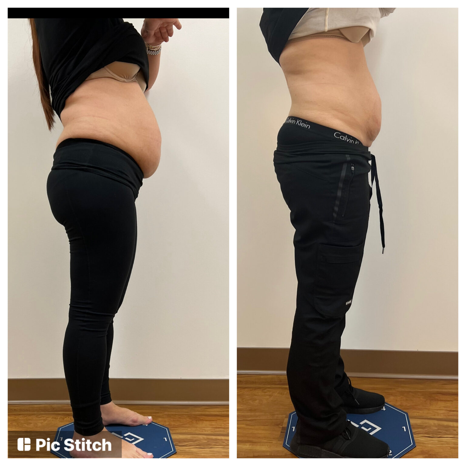 Emsculpt NEO Sherman Oaks CA | Body Contouring