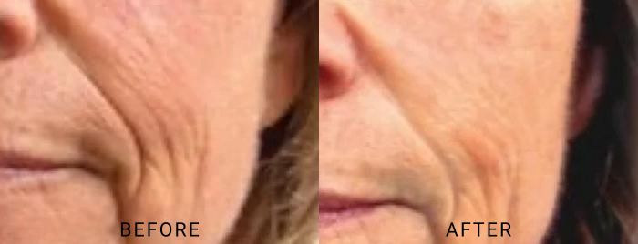 Endermologie | Cellulite Treatment Sherman Oaks CA