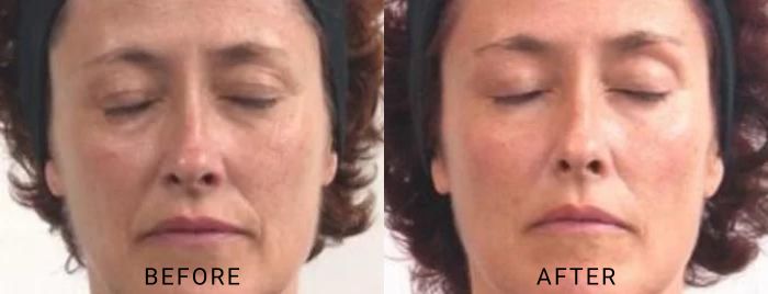 Endermologie | Cellulite Treatment Sherman Oaks CA